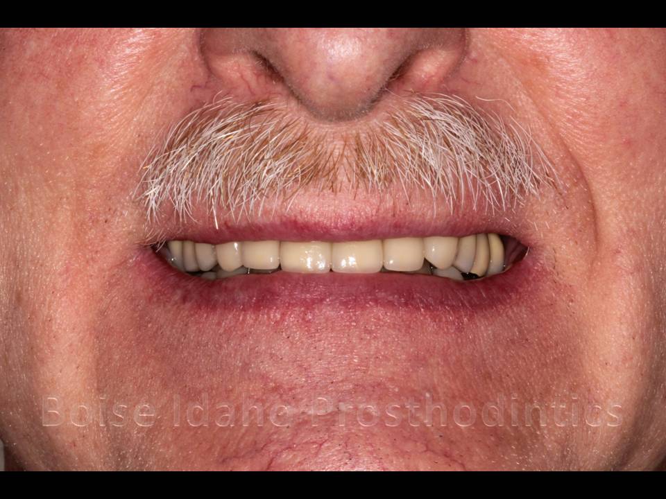 Boise Idaho Prosthodontics: Maxillary Semi-precision RPD with survey ...
