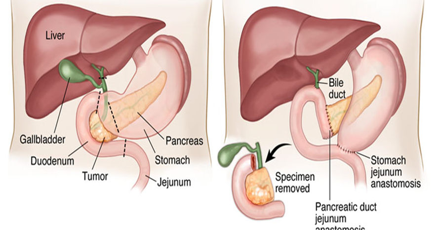 Surgical Educator: PANCREATIC CANCER/ Obstructive Jaundice