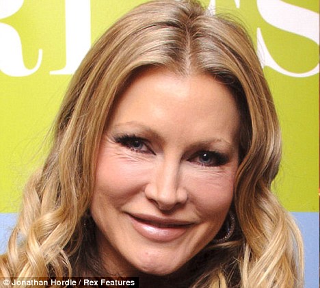 Caprice Plastic Surgery Before and After Browlift and Derma Fillers ...