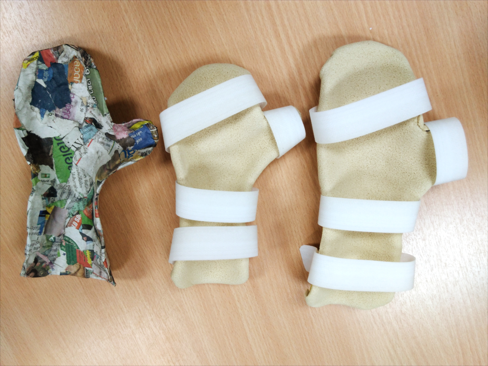 ProgressTH: 3D Printing: Resting Hand Splint Could Save Hospital ...