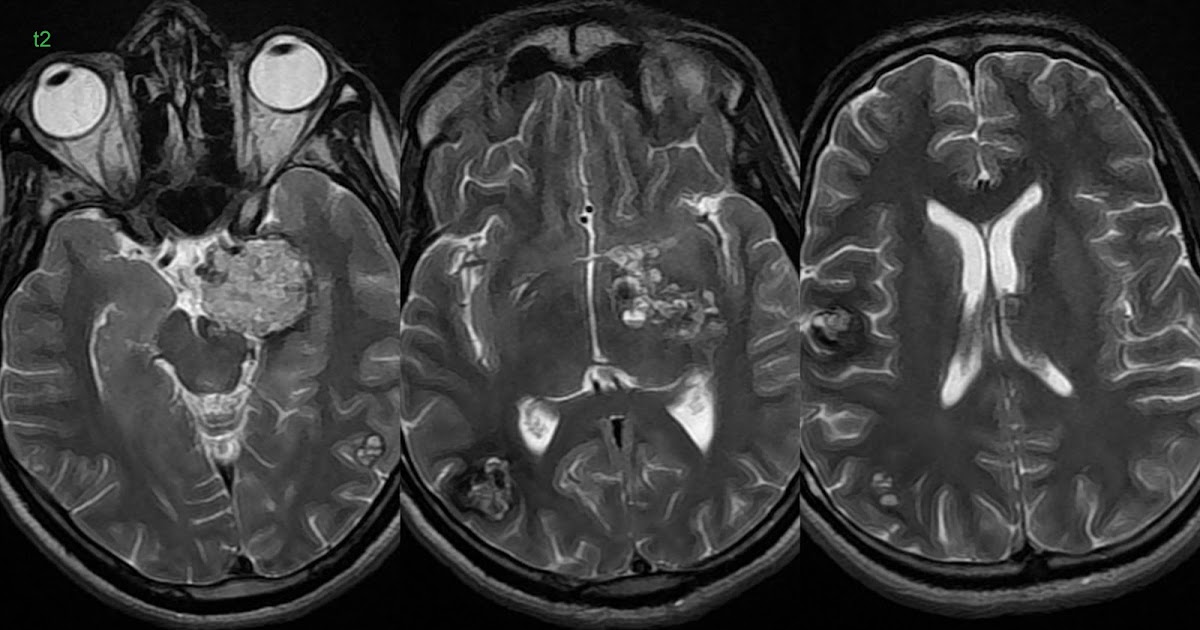 Neuroradiology Cases: Multiple Brain and a Spinal Cavernous ...