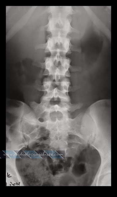 Radiology Archives: Μεταβατικός Oσφυοϊερός Σπόνδυλος - Ιεροποίηση Ο5 ...