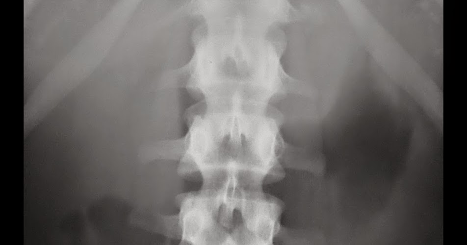 Radiology Archives: Μεταβατικός Oσφυοϊερός Σπόνδυλος - Ιεροποίηση Ο5 ...