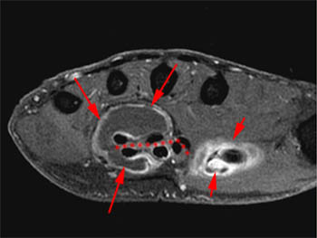 MRI Musculo-Skeletal Section: Classic horseshoe abscess.