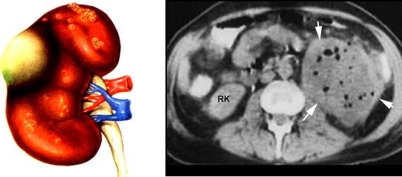 Cuando la infección urinaria es en el mismo riñón