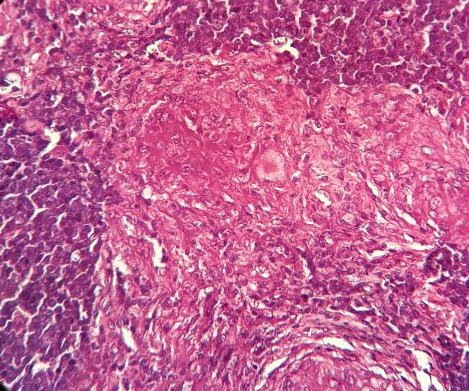 into the roots: Sarcoidosis