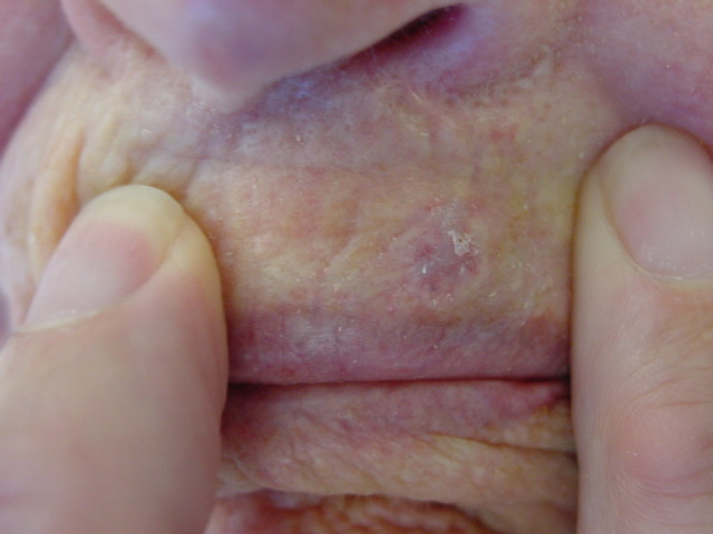 Dermatology For Dentists and Dental Students: Lips