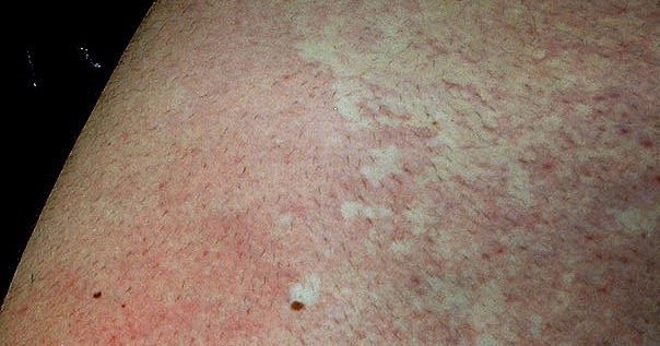 Nevus anemicus - Congenital skin nevus | the dynamic natural skin care