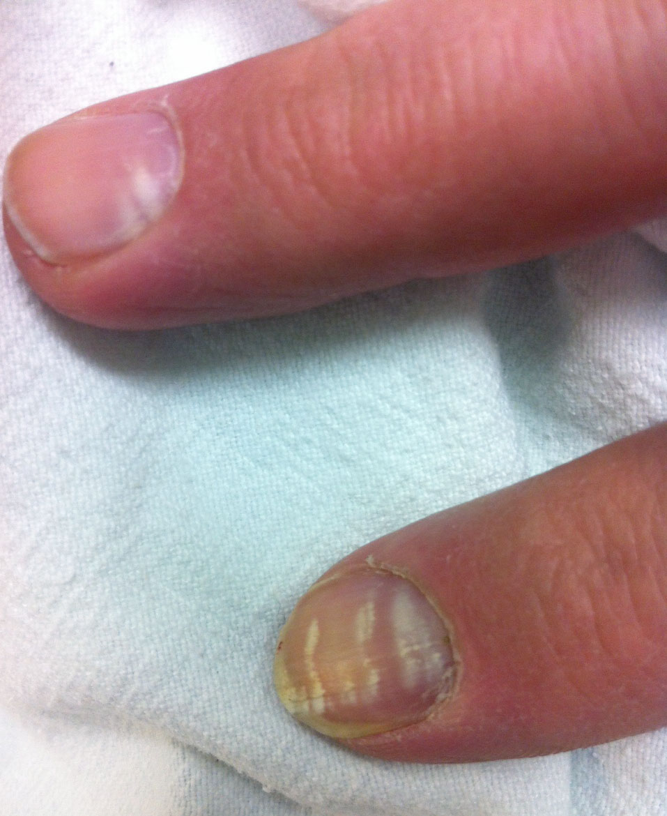 VIRTUAL GRAND ROUNDS IN DERMATOLOGY 2.0: Transverse Leukonychia