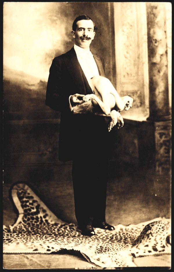 Enfermería y Salud: Siameses: Gemelos Parásitos o Heterópagos