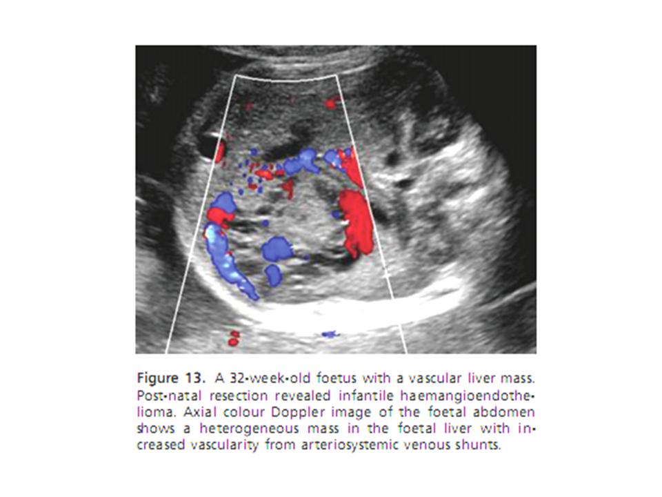 BÀI SOẠN VỀ SIÊU ÂM CHẨN ĐOÁN: Hepatic Vascular Shunts