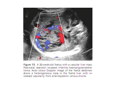 BÀI SOẠN VỀ SIÊU ÂM CHẨN ĐOÁN: Hepatic Vascular Shunts