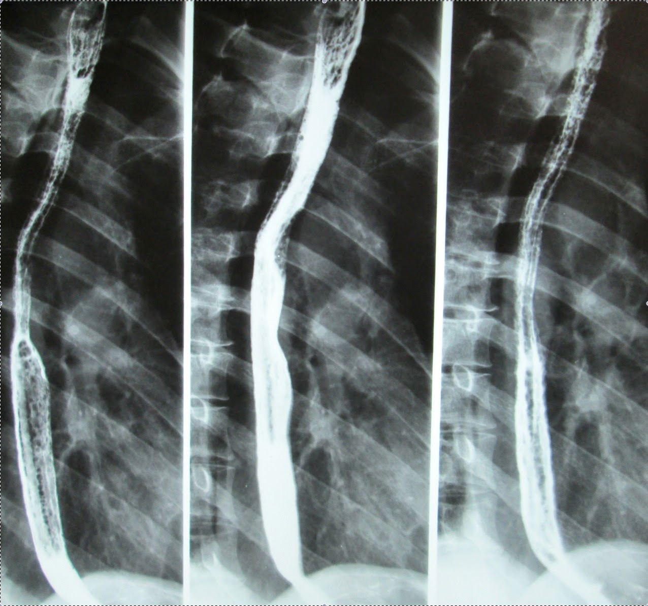 RADIOLOGIA LLEIDA: MONILIASIS ESOFAGICA