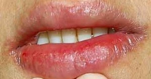 Labios rachados e labios secos - Causas, sintomas e tratamento ...