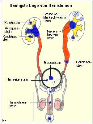 Lithiasis: stone and brick layer forms:Spermatocele