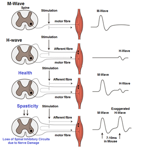 Multiple Sclerosis Research: Controlling Spasticity
