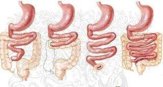 Resección de Intestino Delgado