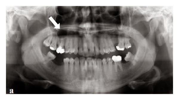 Oro antral fistula | Rahul Shinde Blog