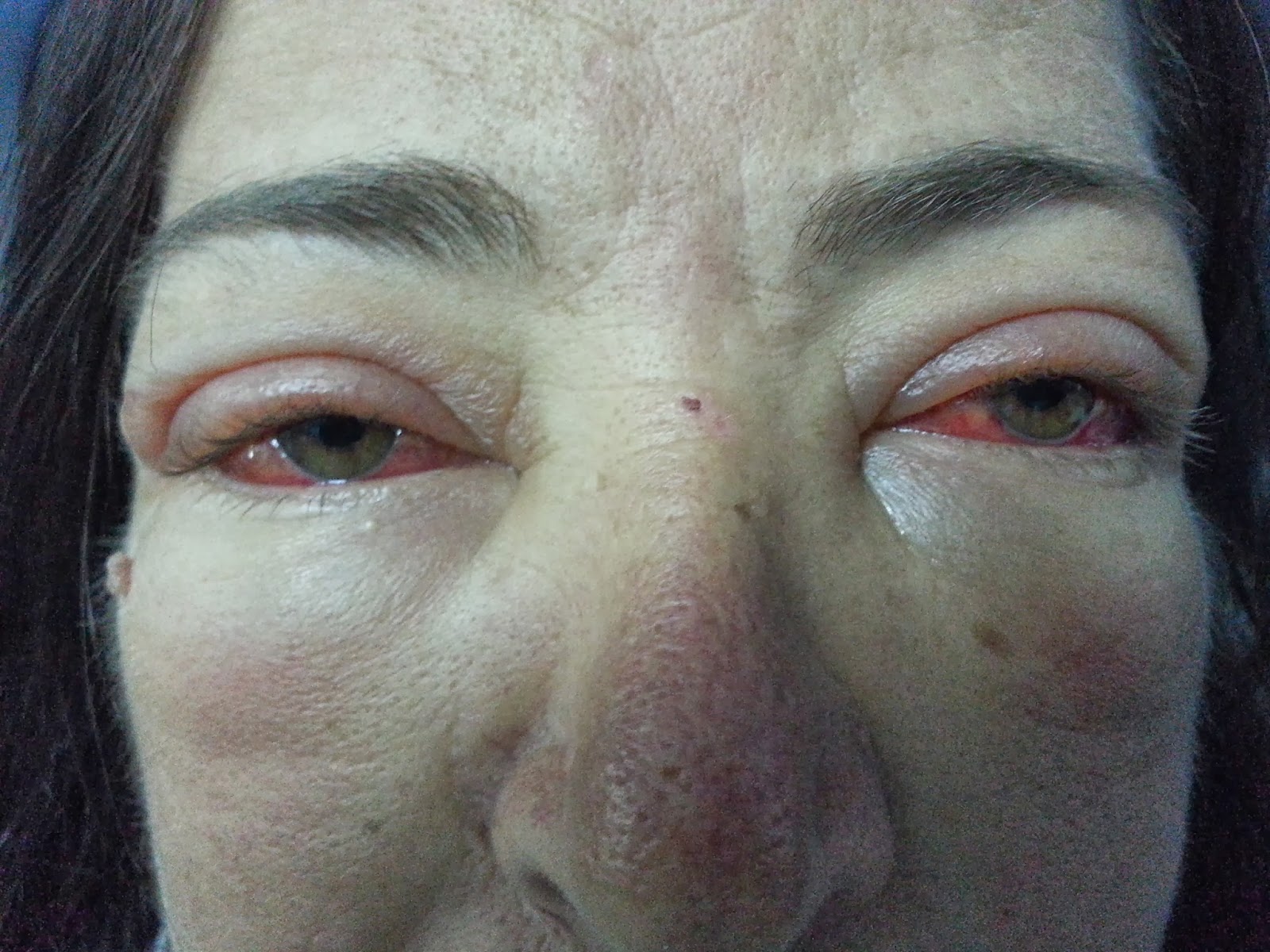 EL RINCÓN DE LA MEDICINA INTERNA: TRIQUINOSIS. BROTE EN AZUL SETIEMBRE 2013