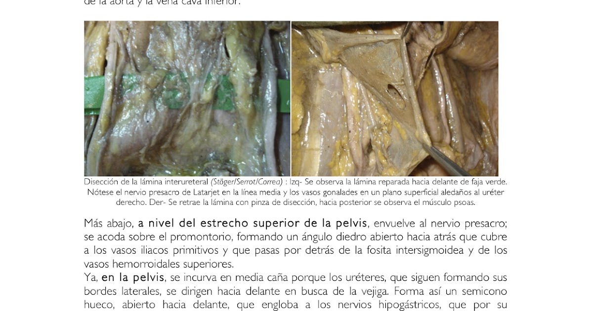 Cuadernos de Anatomía Quirúrgica: La Lámina inter-ureteral de Albanese.