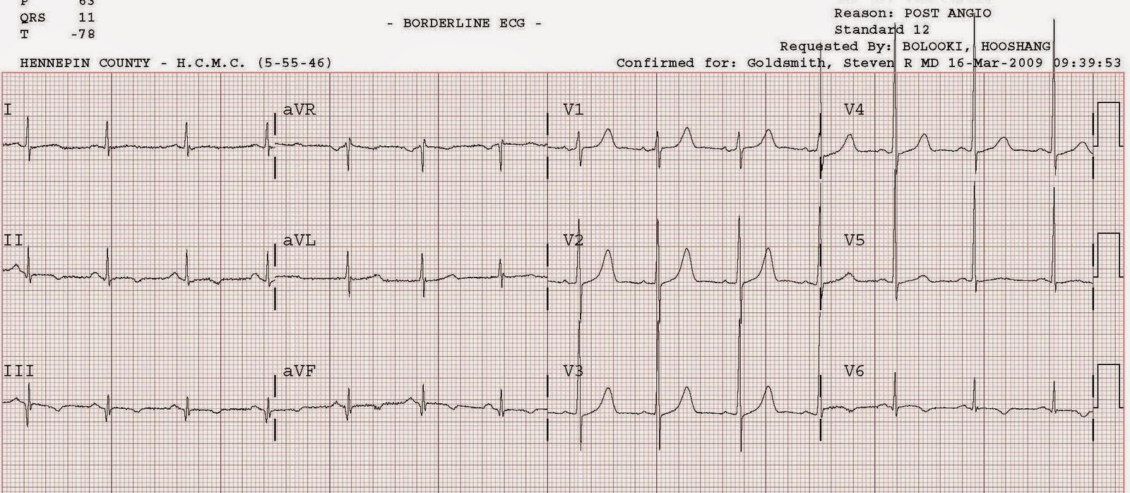 Dr. Smith's ECG Blog: Pure (Isolated) Posterior STEMI -- not so rare ...