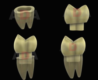 Clínica Dental Flores - Rosales: ¿Qué significa Endocrown o Endocorona?
