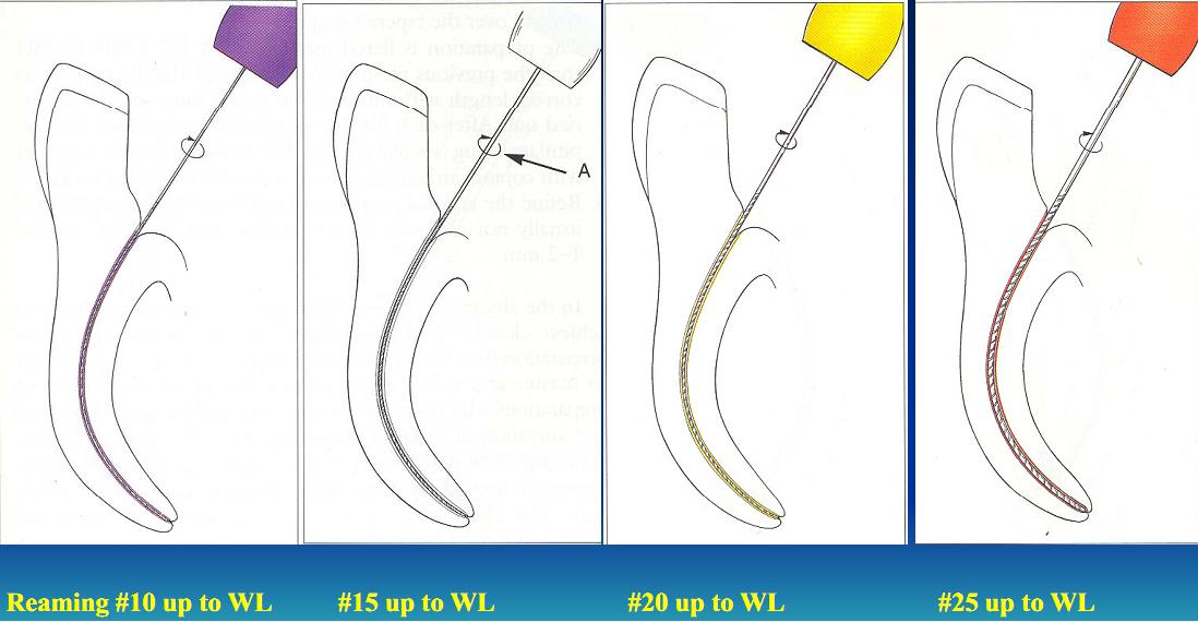 Dentistry Lectures For Mfdsmjdfnbdeore Root Canal Preparation