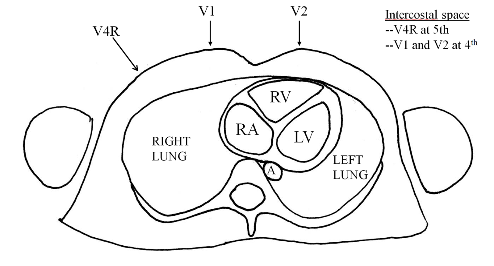 Dr. Smith's ECG Blog: Septal STEMI with ST elevation in V1 and V4R, and ...