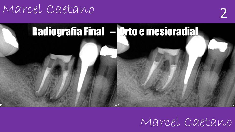 Endodontia Avançada: Anatomia radicular como fator dificultante para ...