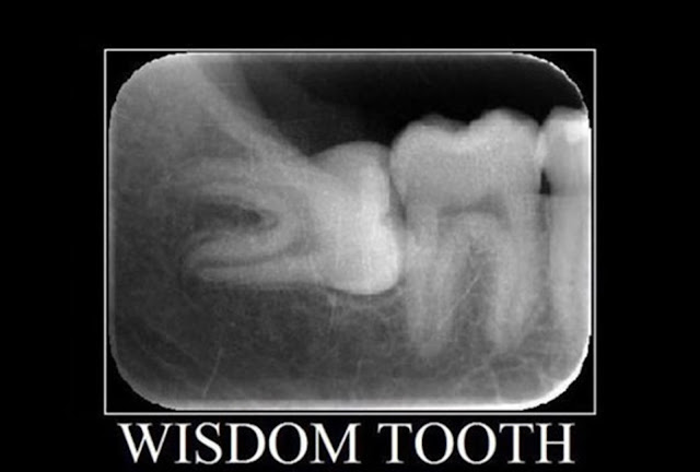 Impacted Wisdom Tooth and Pericoronitis