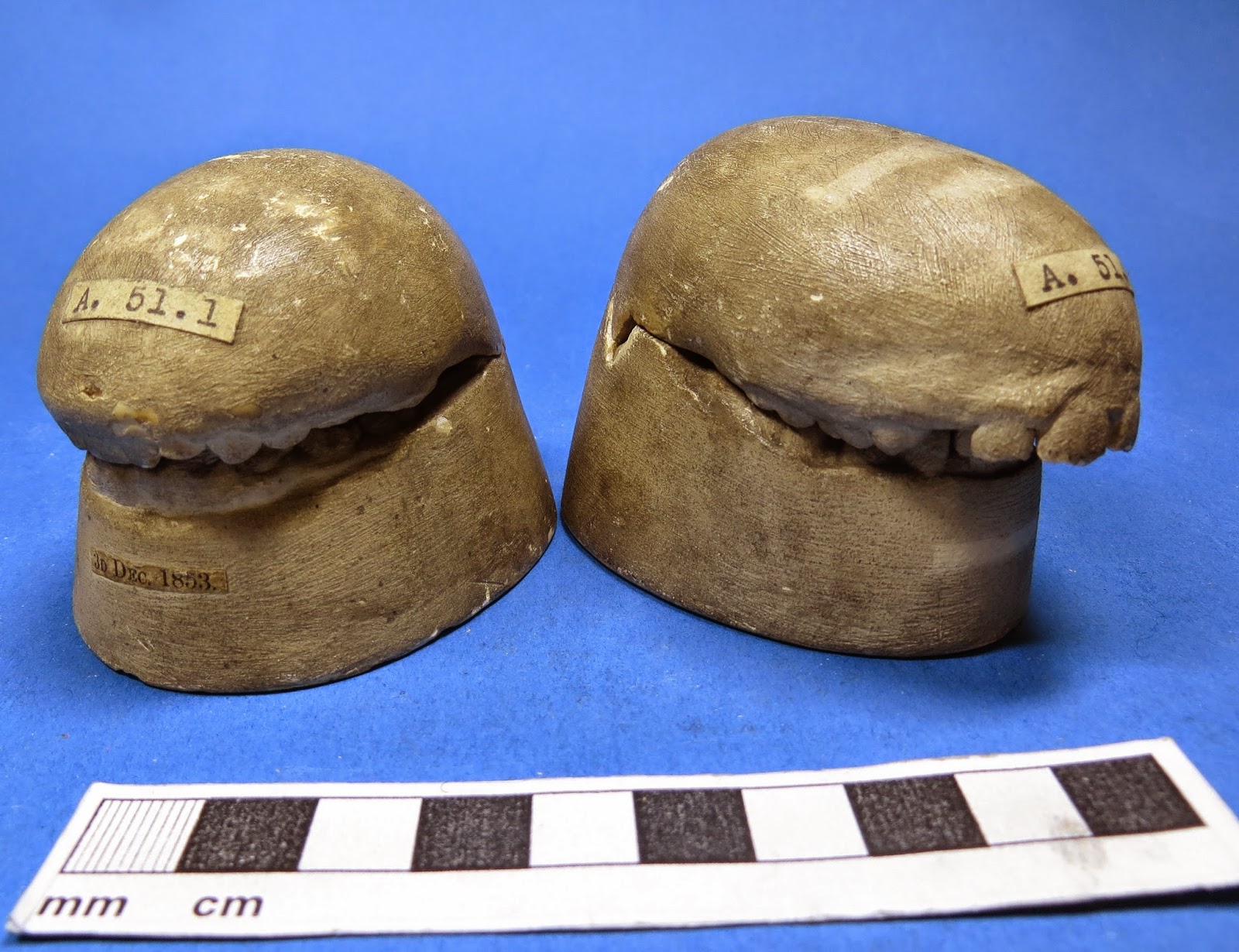 Morbid Anatomy: Dental casts of the Extraordinary Aztec Children, 1853 ...