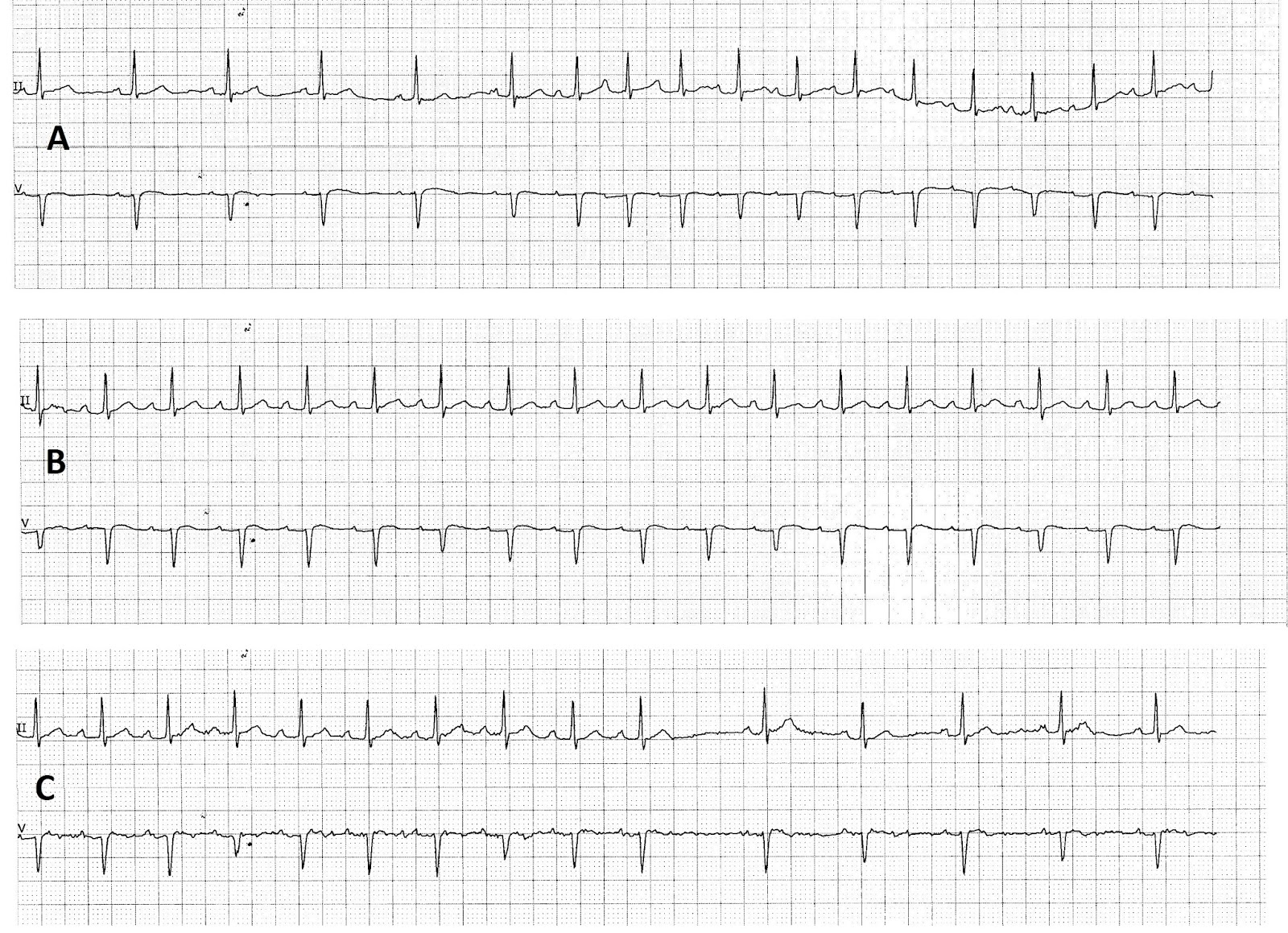 ECG Channel: Atrial Tachycardia