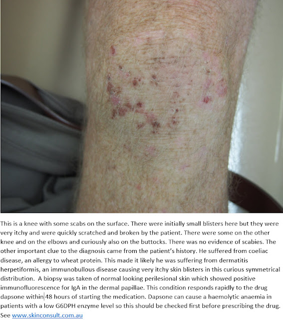 Consultations in Dermatology: Dermatitis herpetiformis