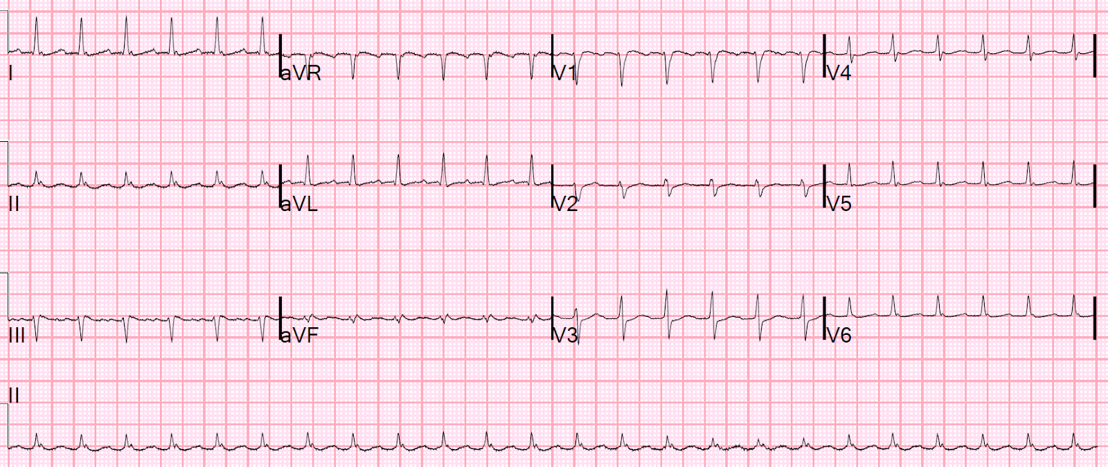 Dr. Smith's ECG Blog: A Middle-Aged Man with Chest pain, Hypotension ...