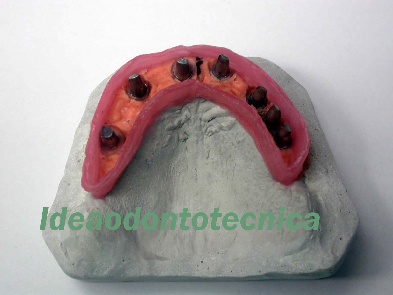 Ideaodontotecnica : la protesi telescopica