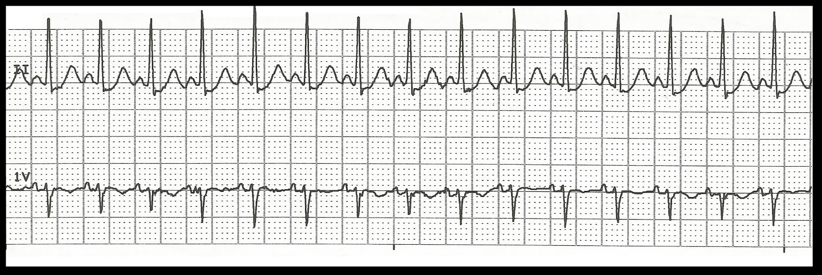 Practice EKG Rhythm Strips 185