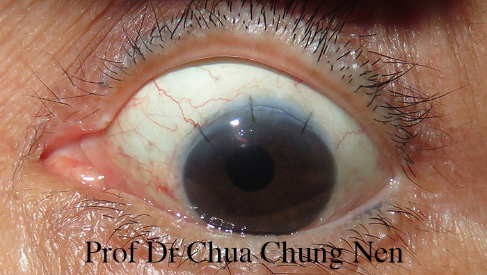 Eyelid Surgery by Prof Dr CN CHUA 蔡鐘能: Doc, Could You Balance My Eyes ...