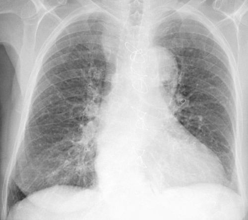 Grace Kaleidoskop: PPOK / COPD