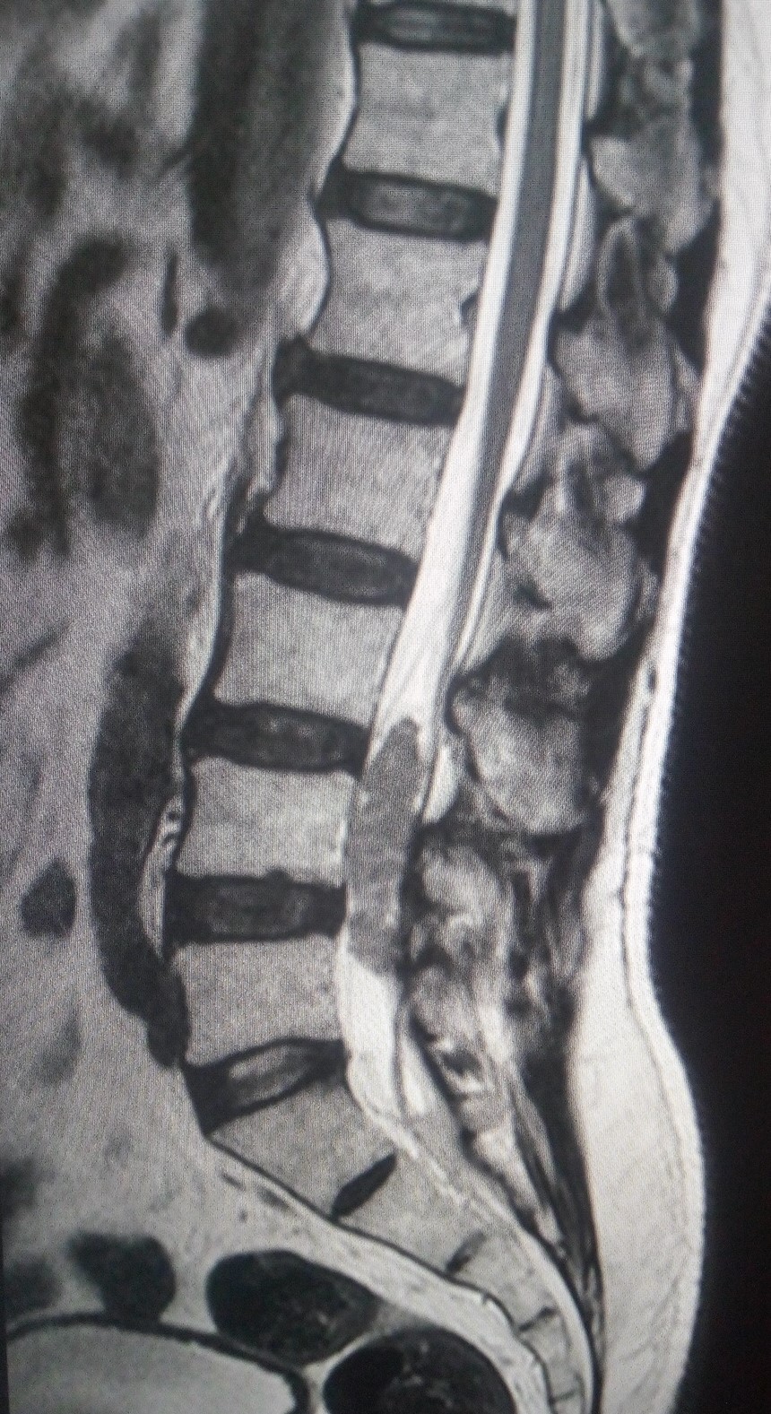 Cauda equina mass: An Approach - Sumer's Radiology Blog