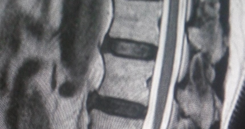 Cauda equina mass: An Approach - Sumer's Radiology Blog