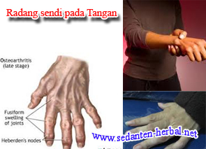 Tips Memperbesar Penis: Radang sendi jari dan pergelangan tangan