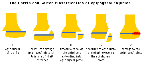 Easy Radiology: SALTER HARRIS CLASSIFICATION- Easy way to learn