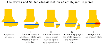 Easy Radiology: SALTER HARRIS CLASSIFICATION- Easy way to learn