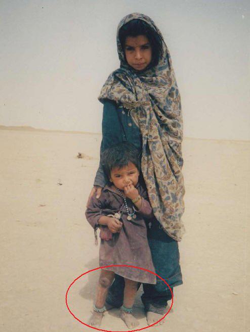 Balochistan Watch: Victims of Pakistan's Nuclear Islamic Bomb, Birth ...