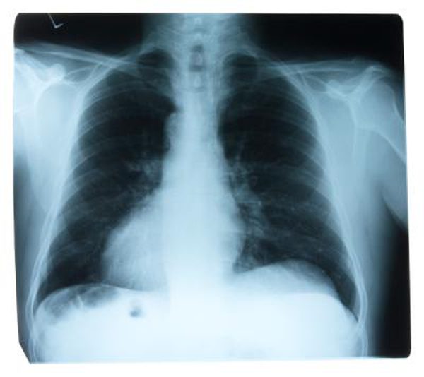 TipsInfoSihat - Maklumat Kesihatan Dan Penjagaan Diri: Paru paru Berair ...