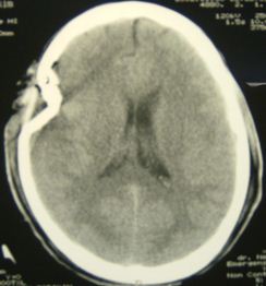 Dr Herry Setya Yudha Utama SpB. FInaCS. MHKes. ICS: Seri Bedah Saraf ...