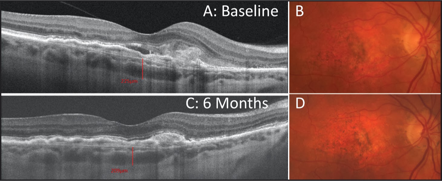 DEGENERACION MACULAR : NEOVASOS E ISQUEMIA. OCT