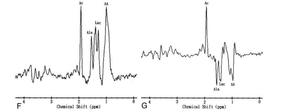 Ultimate Radiology : Proton MR Spectroscopy - ppm of Minor Metabolites