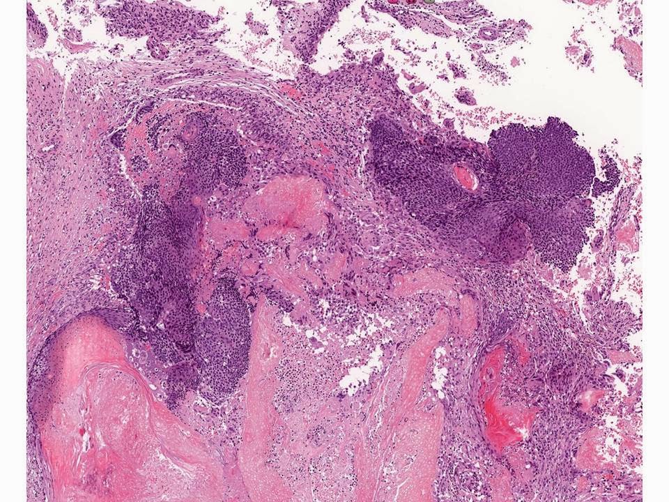 Dermpath Made Simple - Neoplastic: Pilomatrixoma