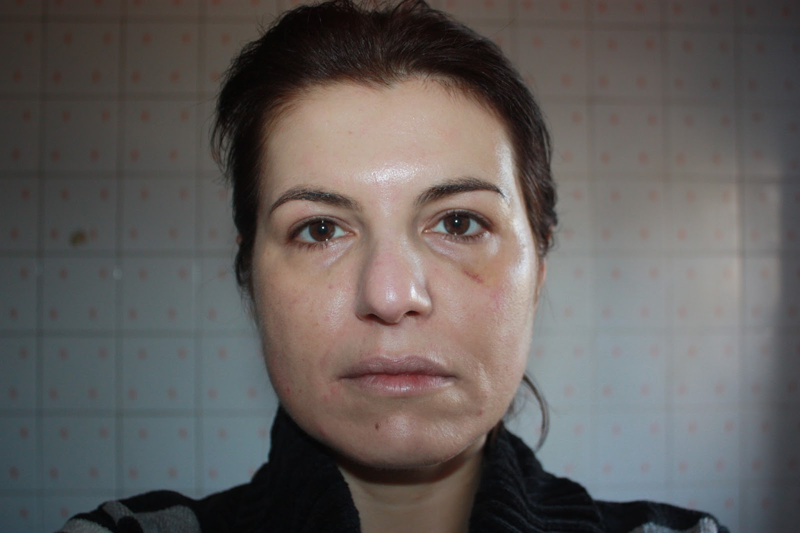 Dear Skin: LIPOGEMS TRETMAN AUTOLOGNIH MATIČNIH STANICA IZ MASNOG TKIVA